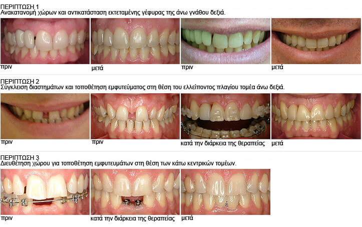 Προπροσθετική ορθοδοντική - Bestsmiles Ορθοδοντικός Οδοντίατρος ...